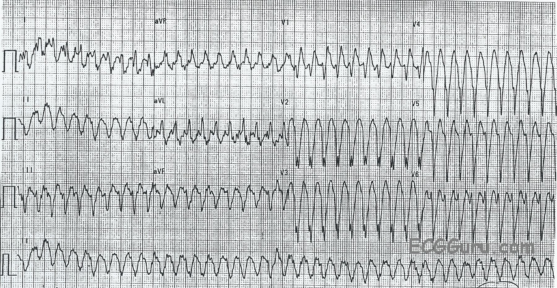 Aberrant conduction | ECG Guru - Instructor Resources
